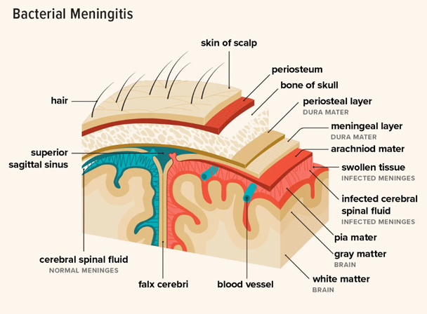 Meningitis Outbreak: All you need to know about its symptoms, causes ...